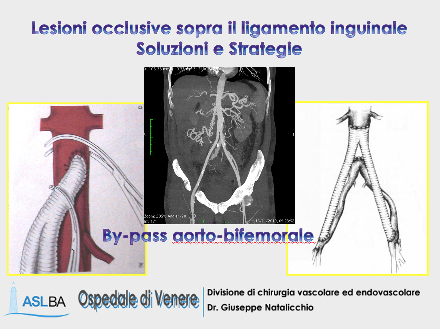 Trattamento chirurgico patologia occlusiva periferica – Dottor Natalicchio